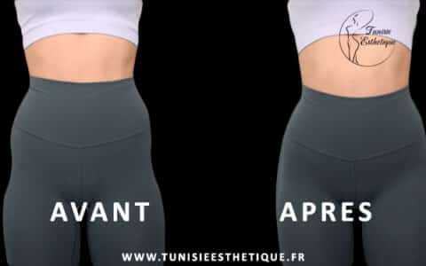 Hip dips : c’est quoi ? - Tunisie Esthetique